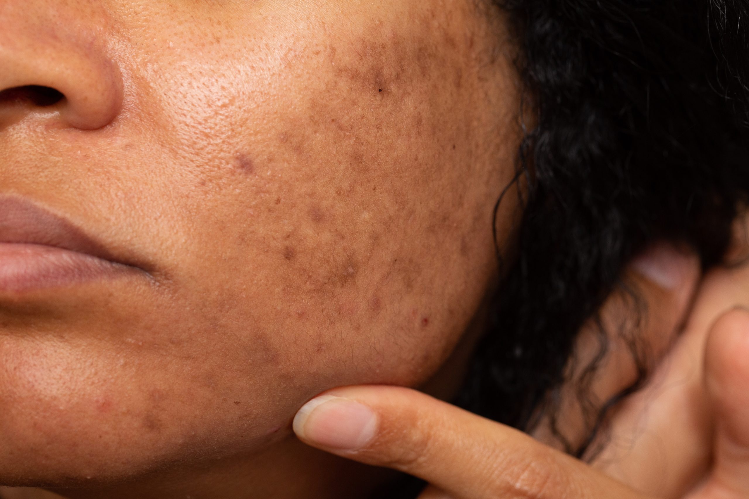 Las Manchas De Tu Cara son Melasma Ferbos Medic